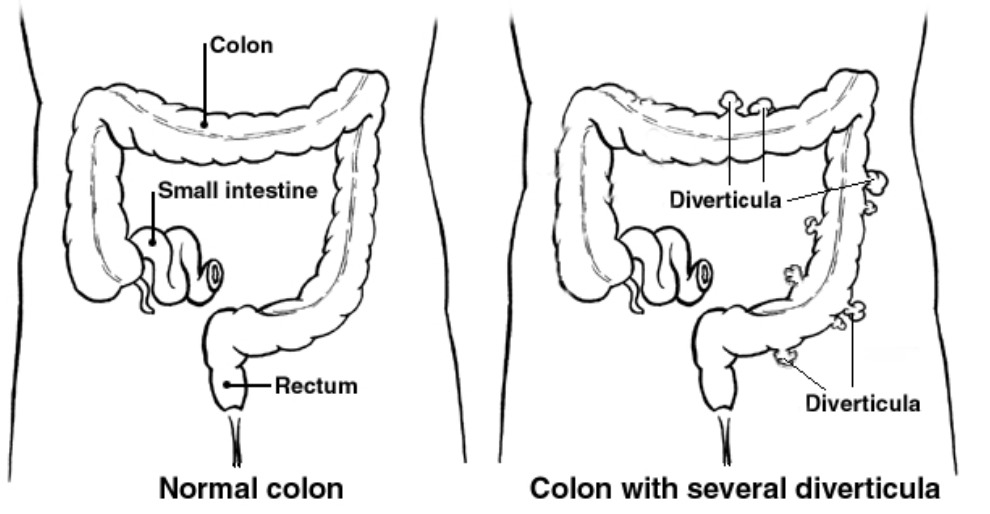 Diverticula